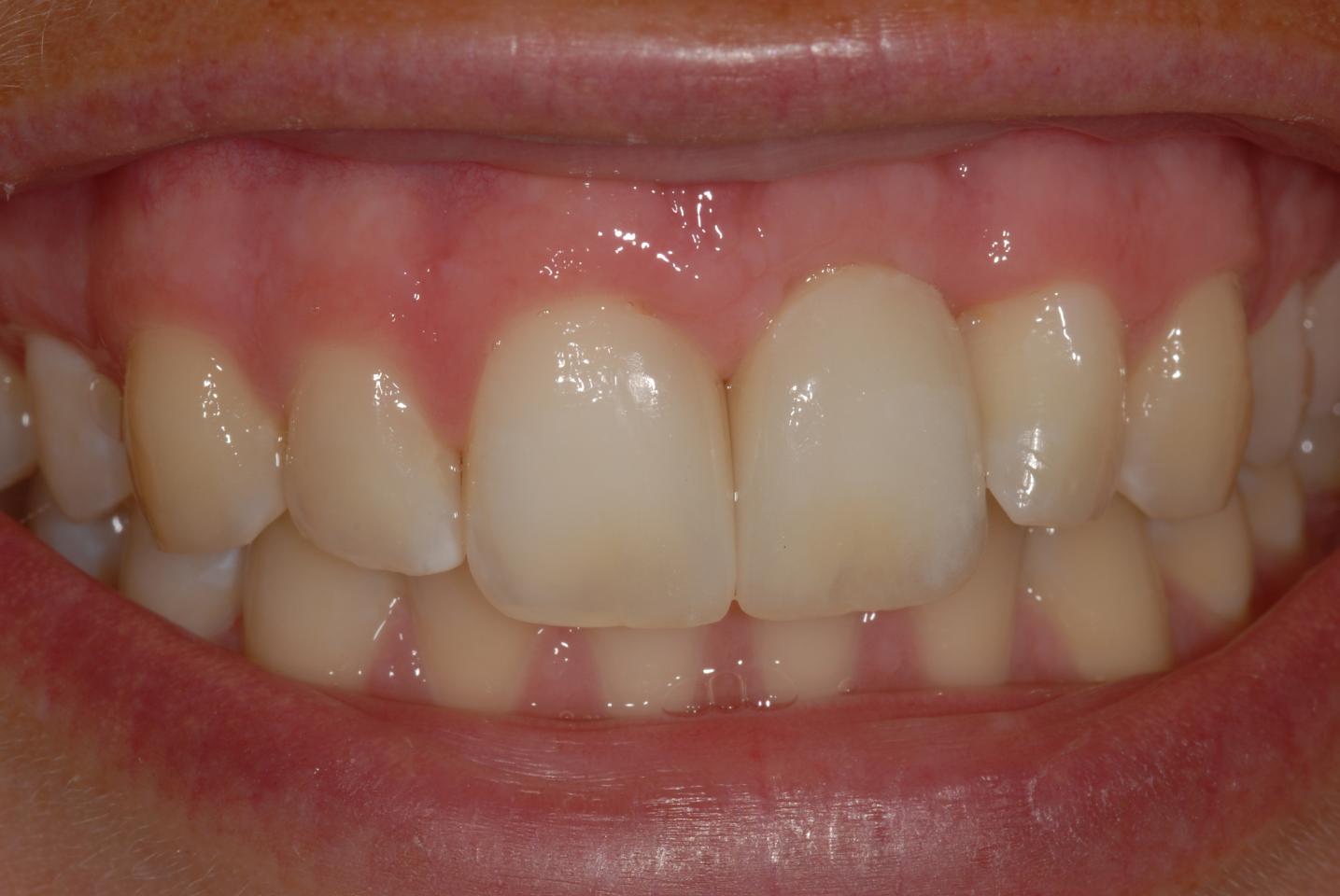 Articles - Forum Implantologicum - ITI