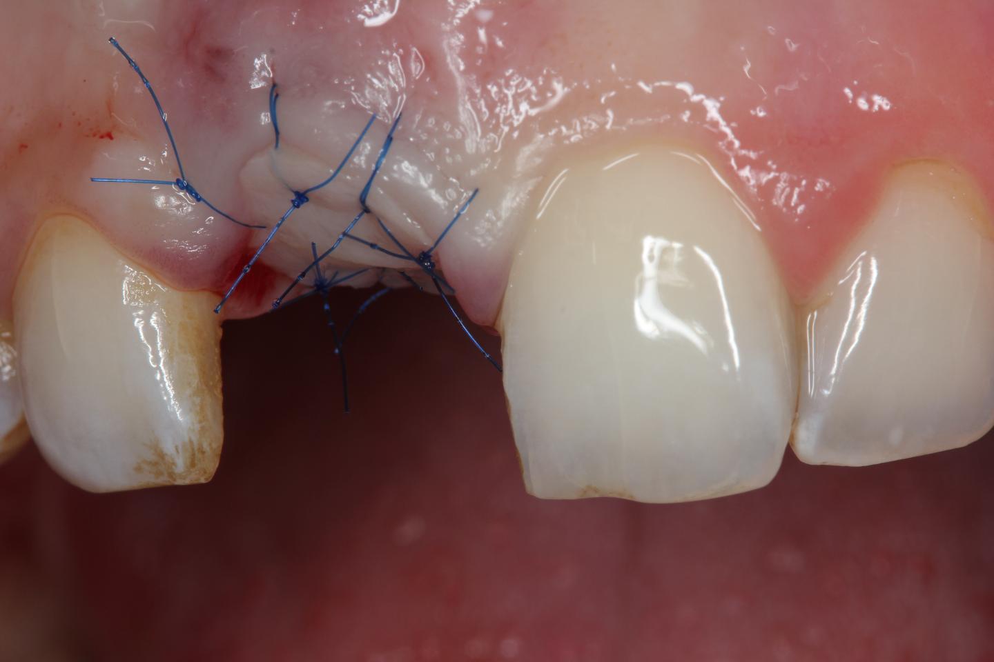 Articles - Forum Implantologicum - ITI