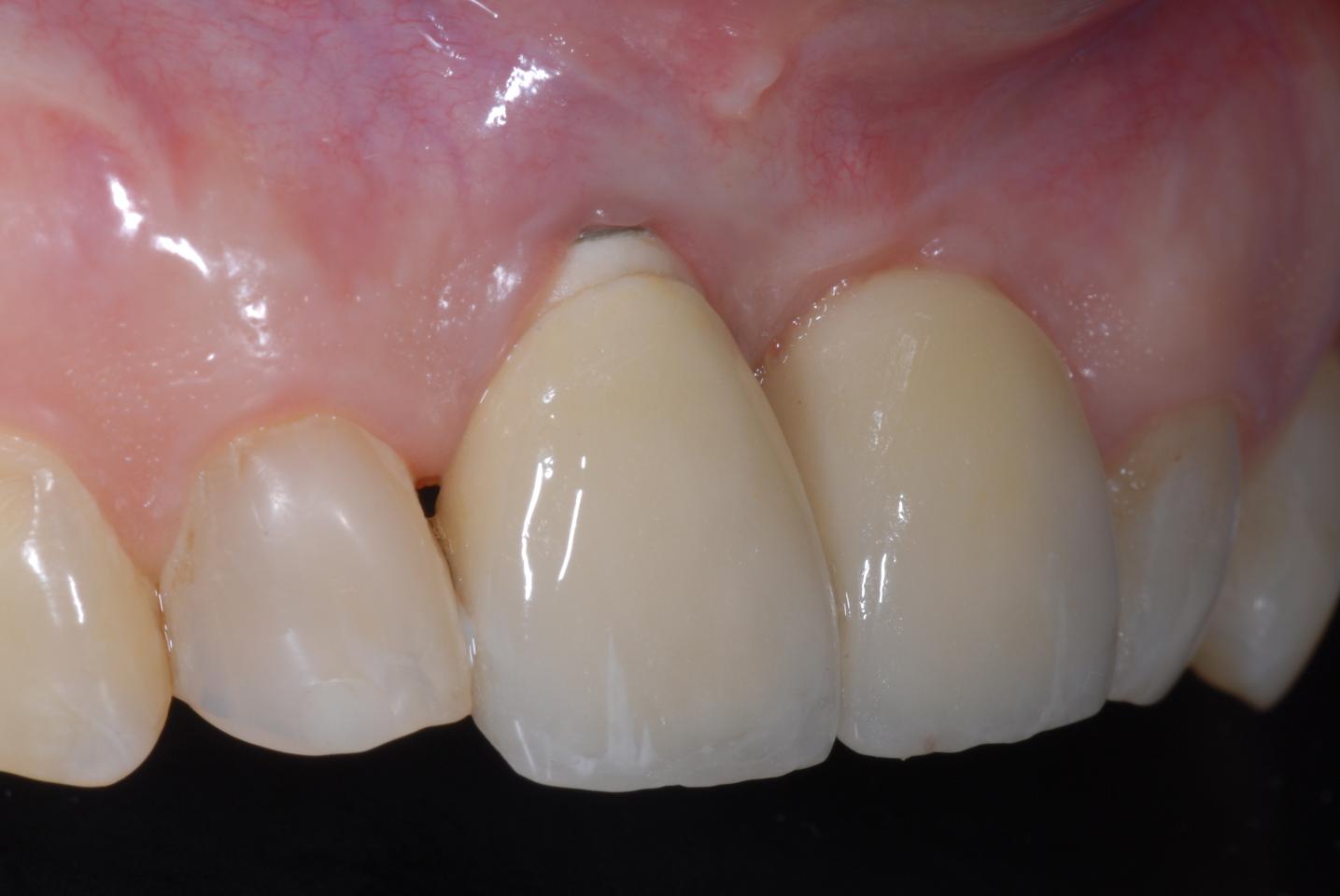 Articles - Forum Implantologicum - ITI