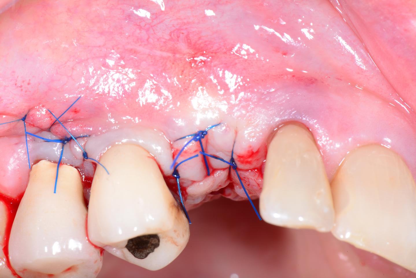 Articles - Forum Implantologicum - ITI