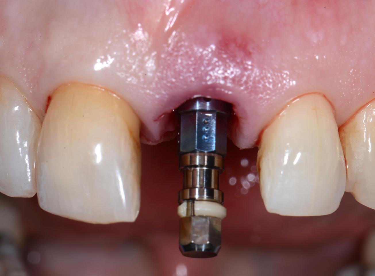 Articles - Forum Implantologicum - ITI