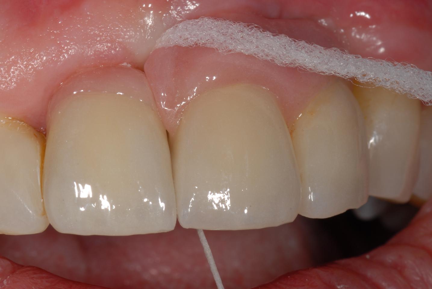 Articles - Forum Implantologicum - ITI