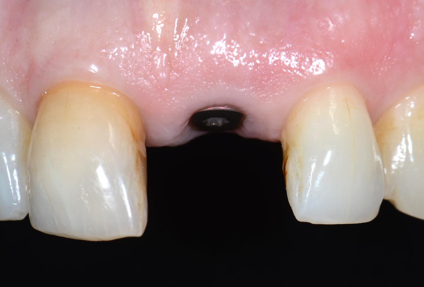 Articles - Forum Implantologicum - ITI