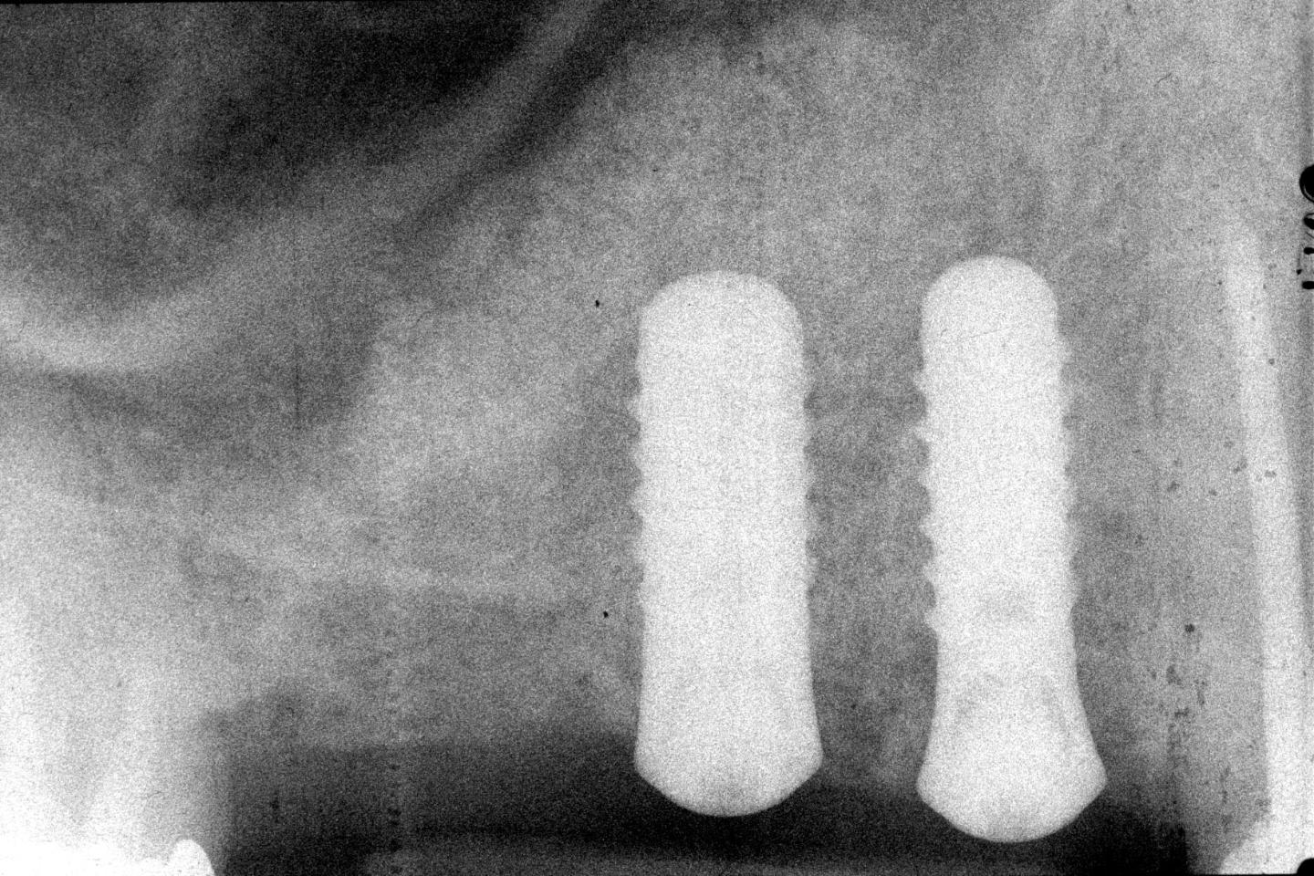 Articles - Forum Implantologicum - ITI