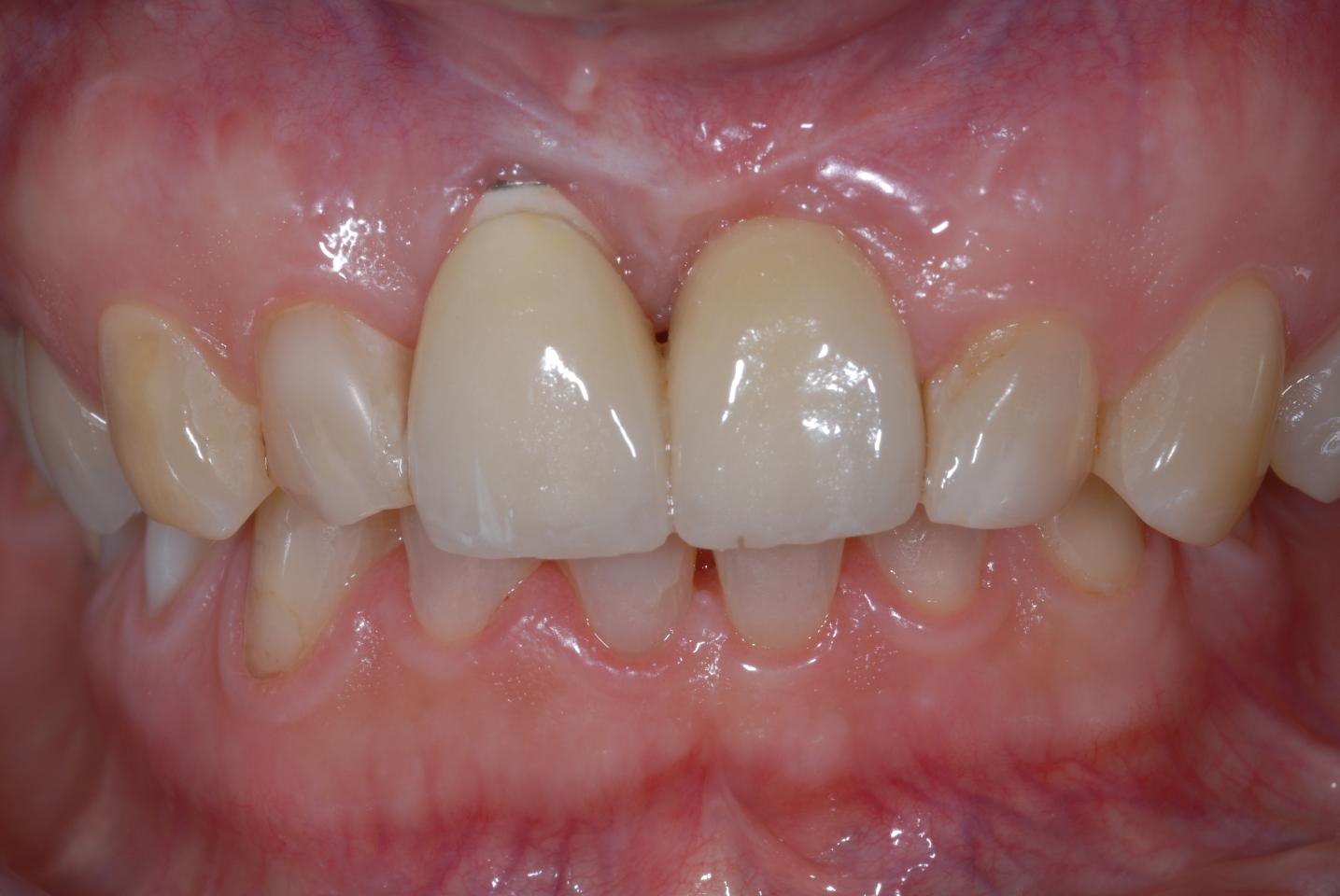 Articles - Forum Implantologicum - ITI