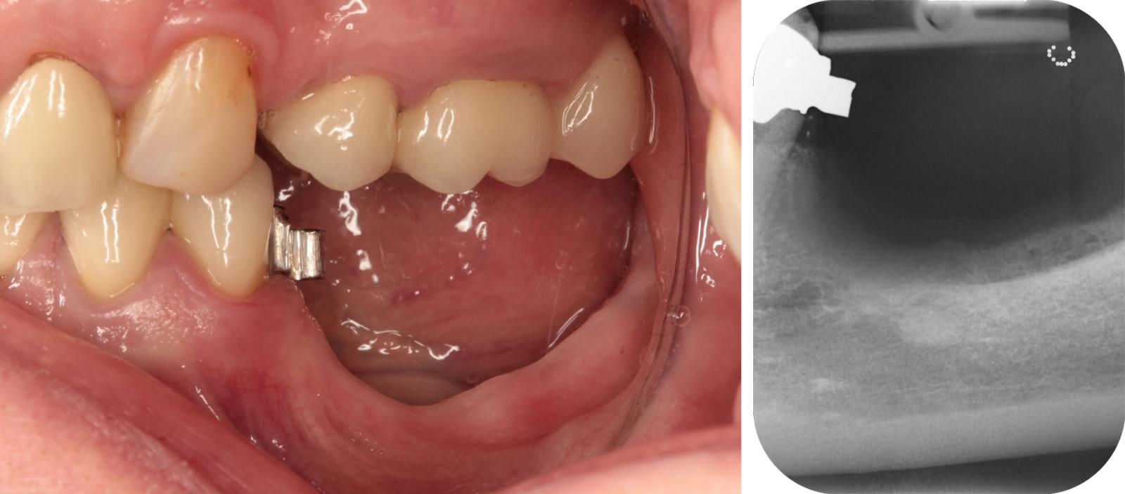 Articles - Forum Implantologicum - ITI