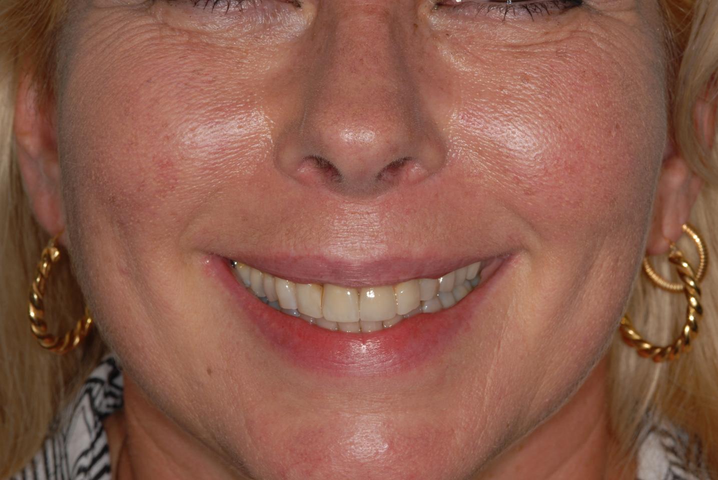 Articles - Forum Implantologicum - ITI