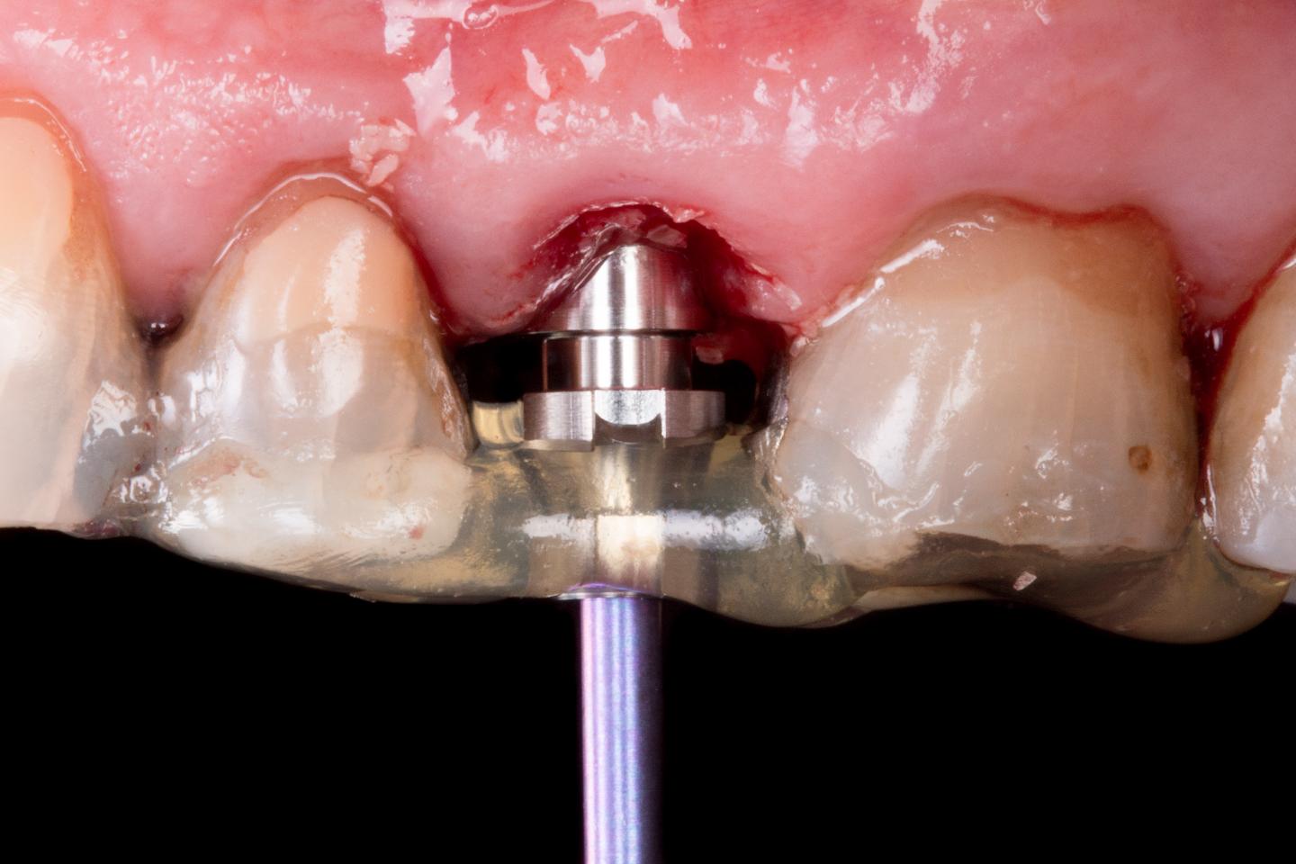 Articles - Forum Implantologicum - ITI