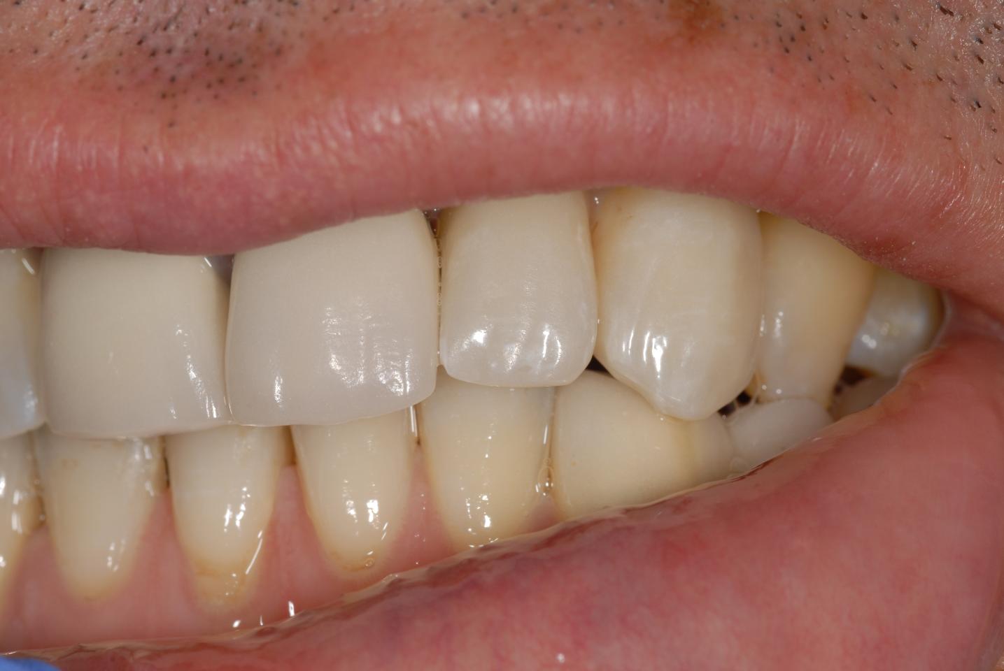 Articles - Forum Implantologicum - ITI