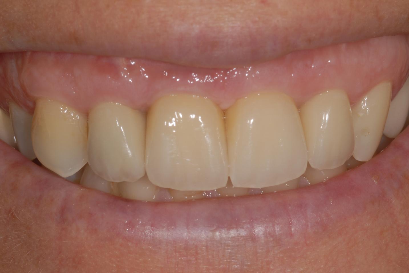 Articles - Forum Implantologicum - ITI