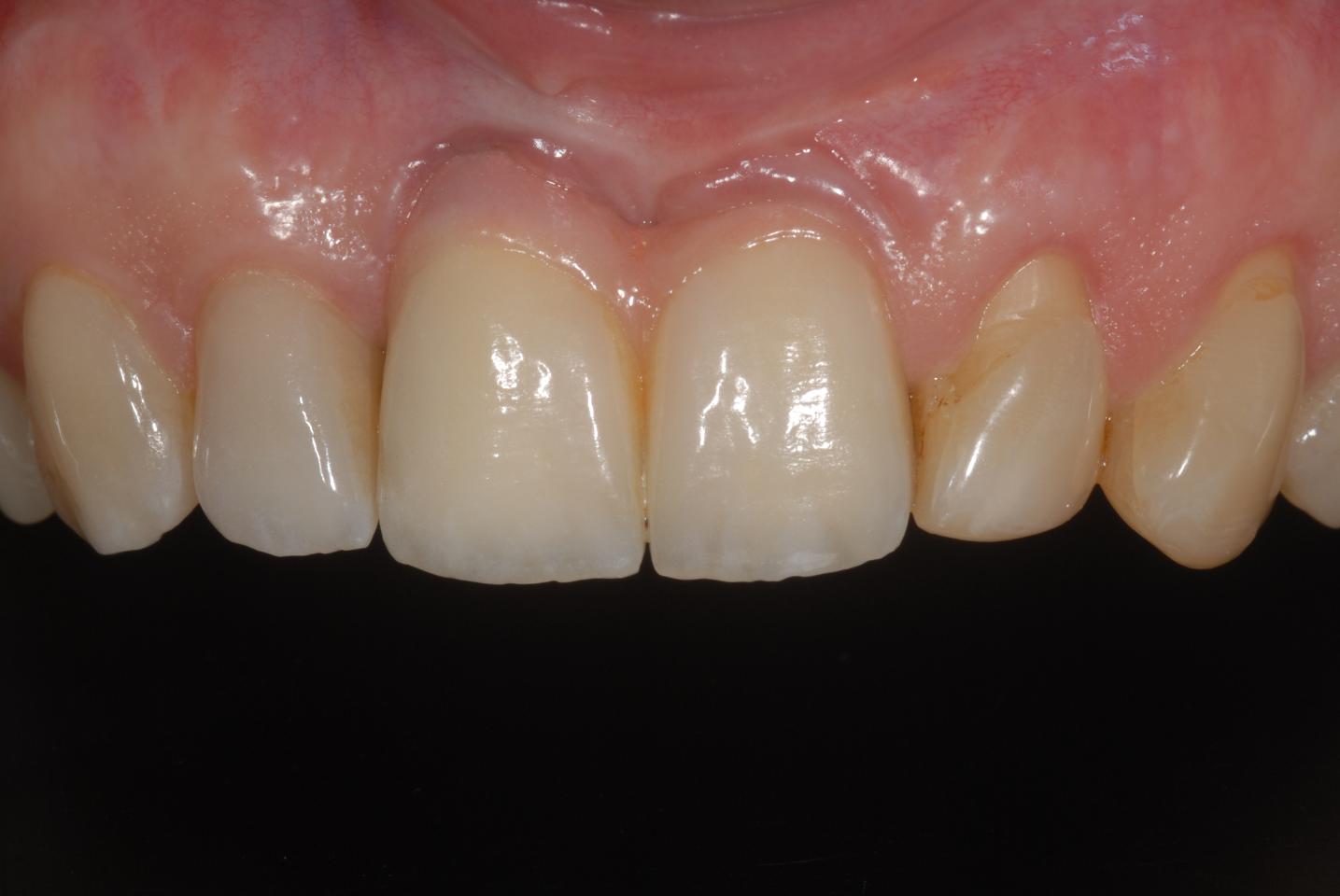 Articles - Forum Implantologicum - ITI