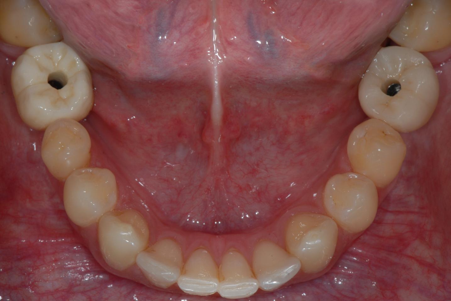 Articles - Forum Implantologicum - ITI