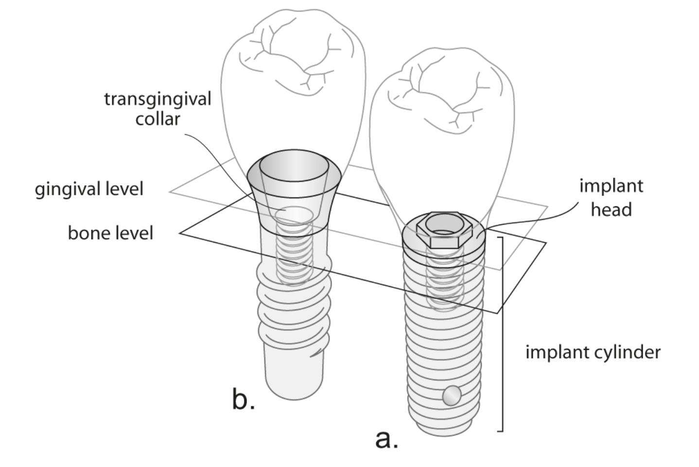 Articles - Forum Implantologicum - ITI