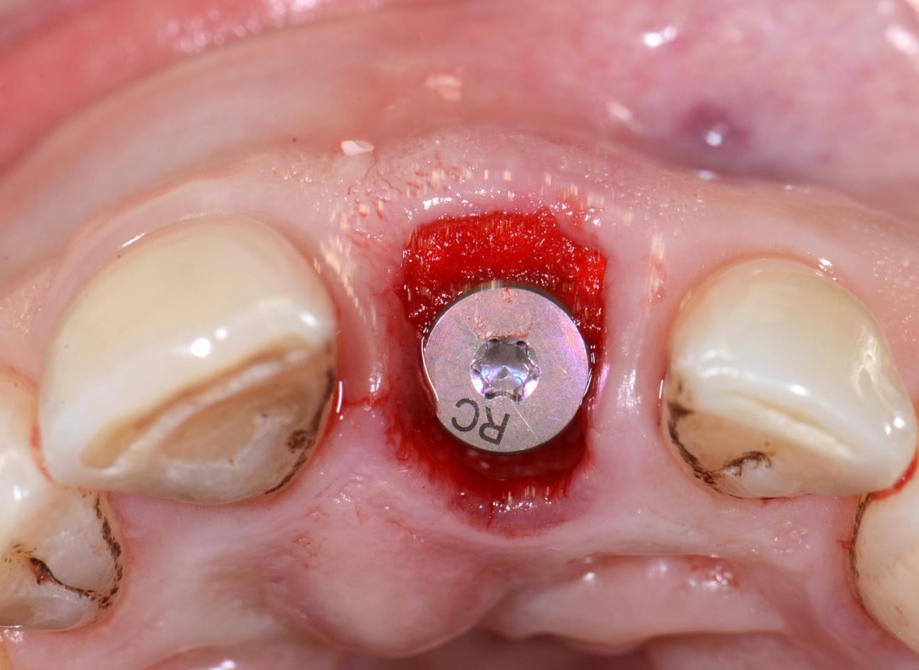 Articles - Forum Implantologicum - ITI