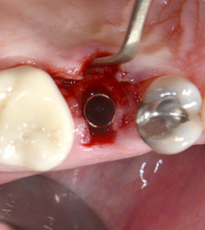 Articles - Forum Implantologicum - ITI