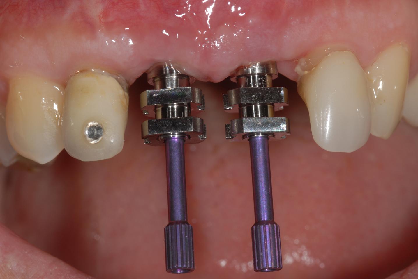 Articles - Forum Implantologicum - ITI