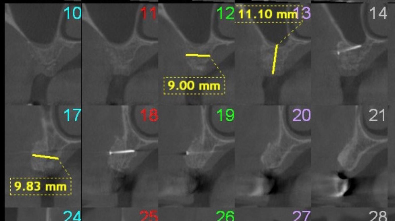 Articles - Forum Implantologicum - ITI