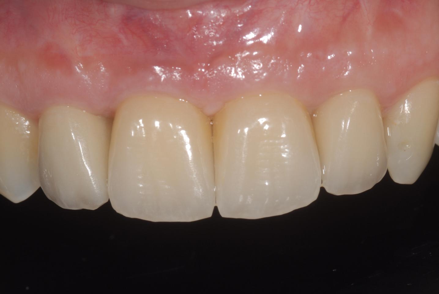 Articles - Forum Implantologicum - ITI