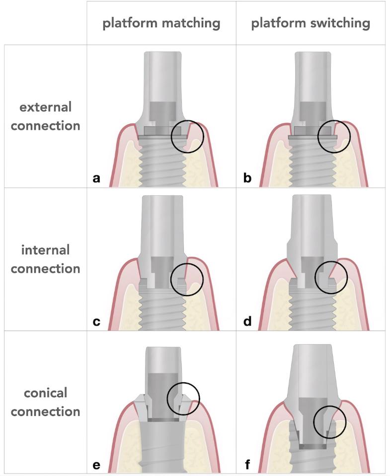 Articles - Forum Implantologicum - ITI