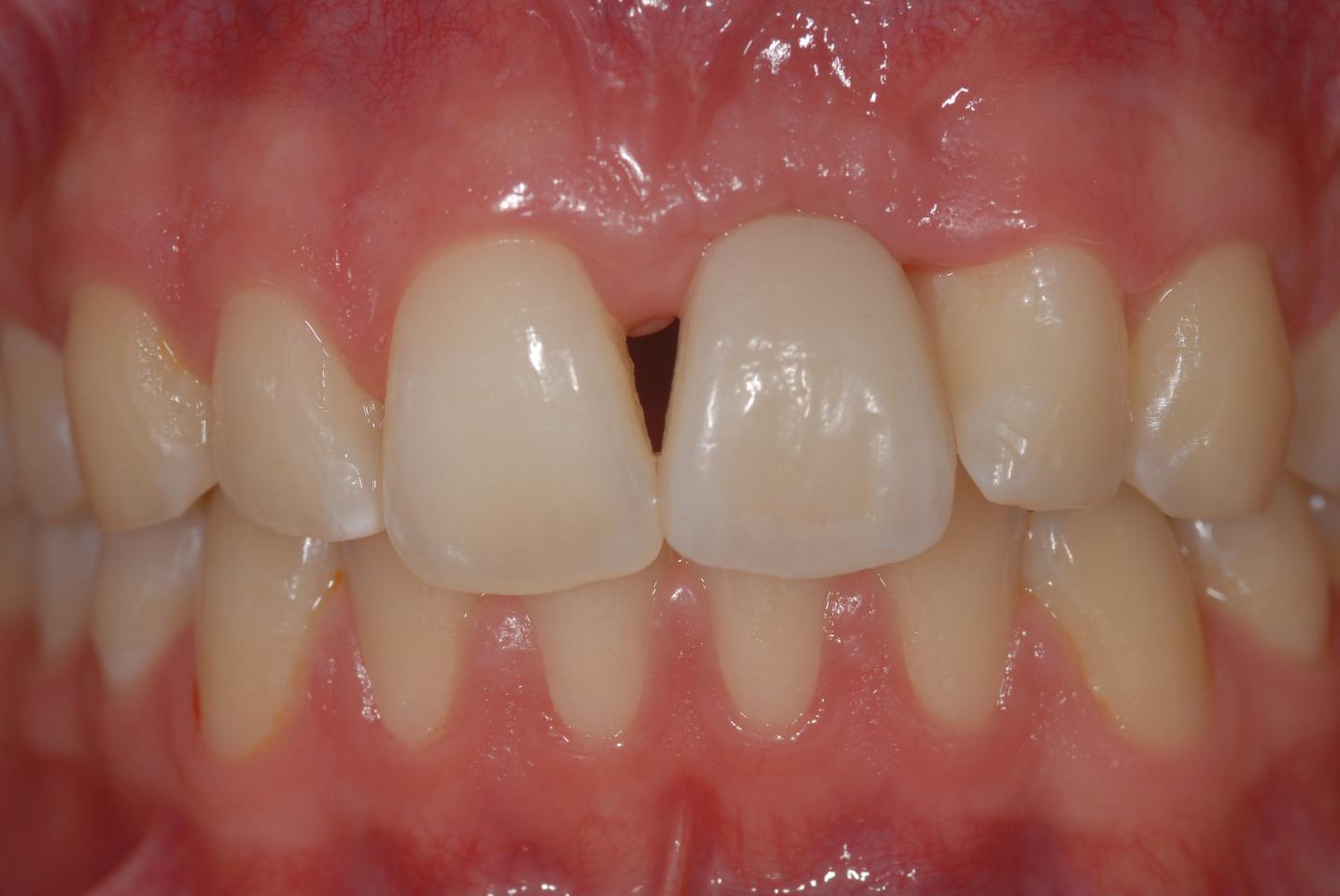 Articles - Forum Implantologicum - ITI