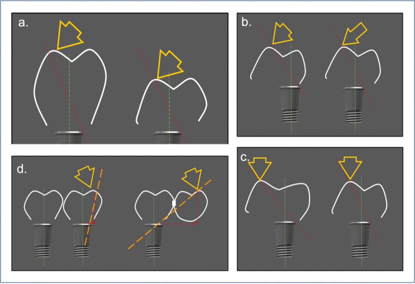 Articles - Forum Implantologicum - ITI
