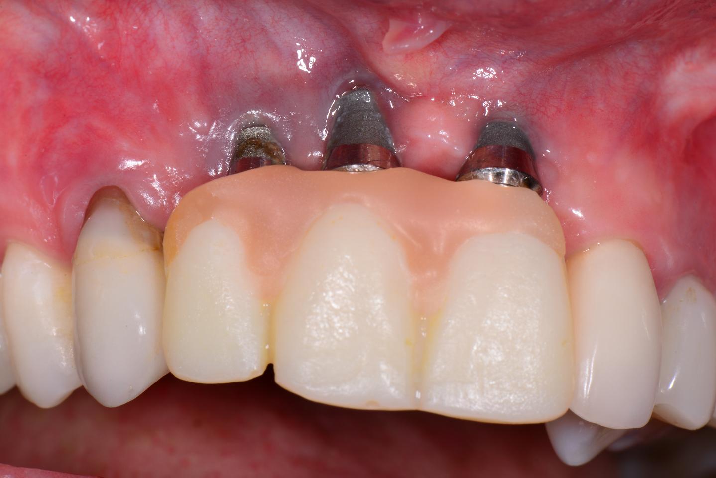 Articles - Forum Implantologicum - ITI