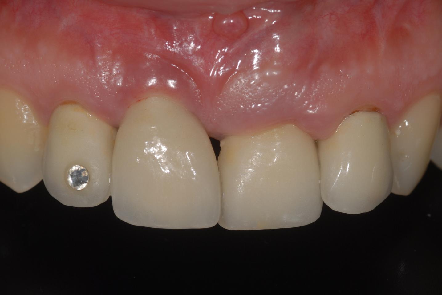 Articles - Forum Implantologicum - ITI