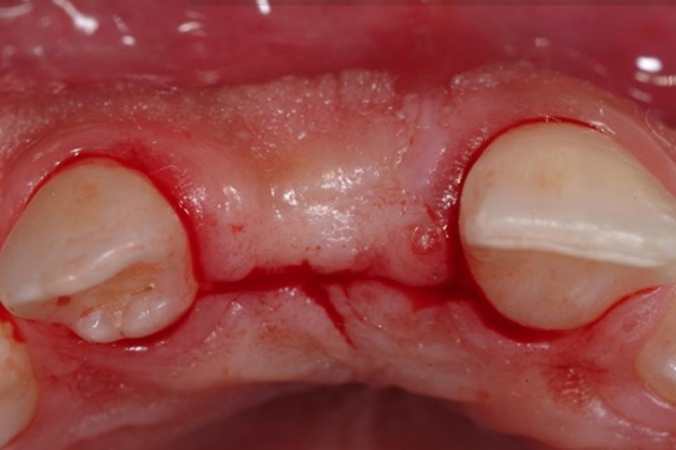 Articles - Forum Implantologicum - ITI