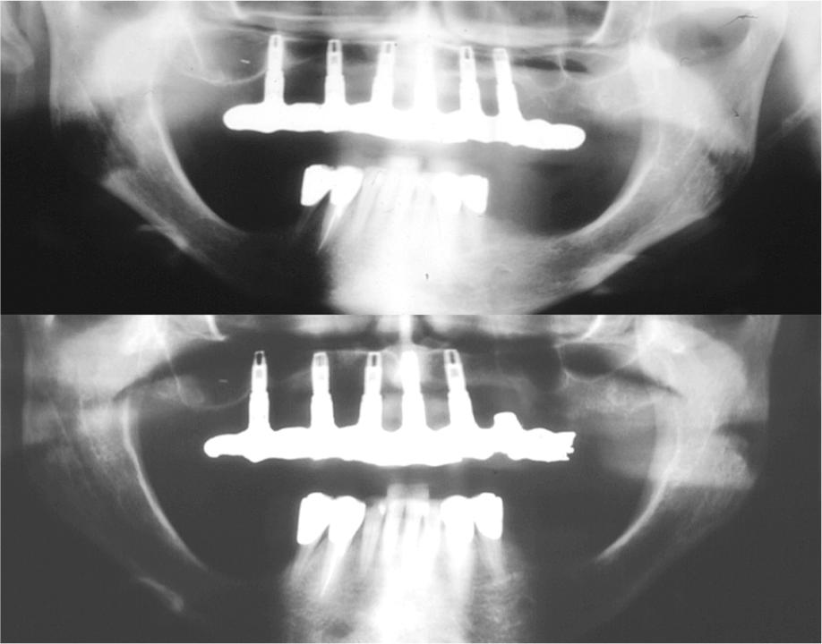 Articles - Forum Implantologicum - ITI