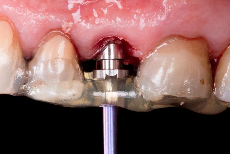 Articles - Forum Implantologicum - ITI