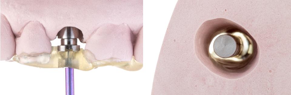 Articles - Forum Implantologicum - ITI